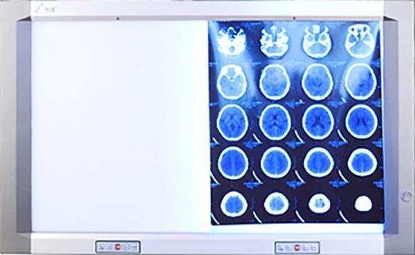 X-Ray Film Viewer - Medicare